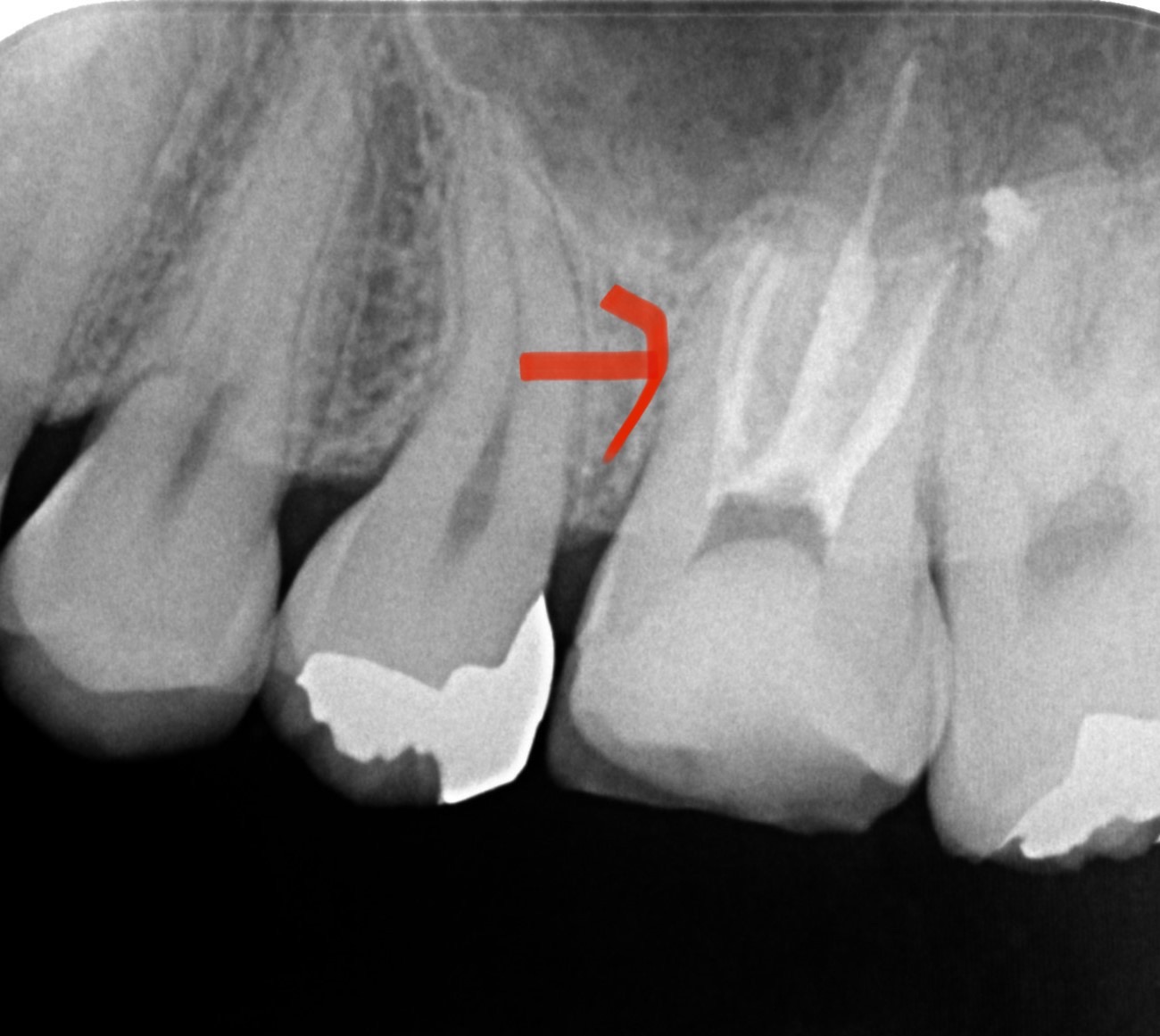 MB2の発現率について｜柏駅東口徒歩8分の歯医者 大島歯科クリニック｜一般歯科・入れ歯・口腔外科